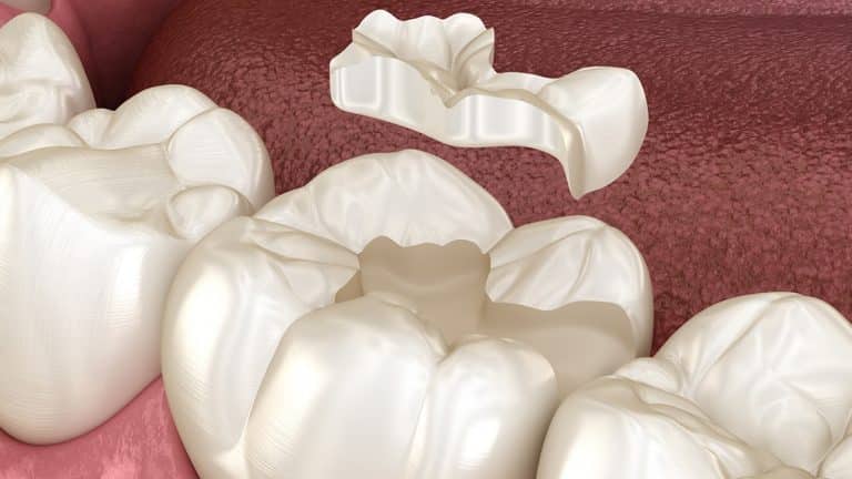 Dental Inlays and Onlays in Waco, TX | Starr General Dentistry