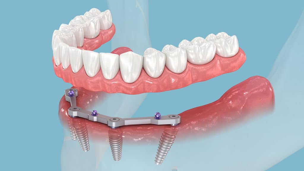 Full Arch Implant Solutions – Starr General Dentistry