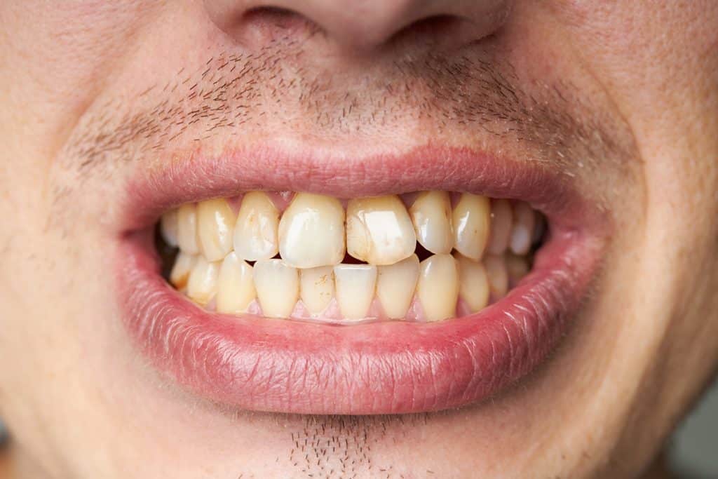 Composite vs. Amalgam Fillings: Key Differences Explained